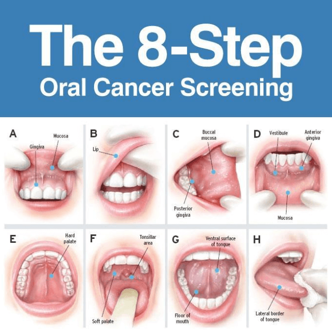 Novembre est le mois du cancer oral - DentisteALaval.com