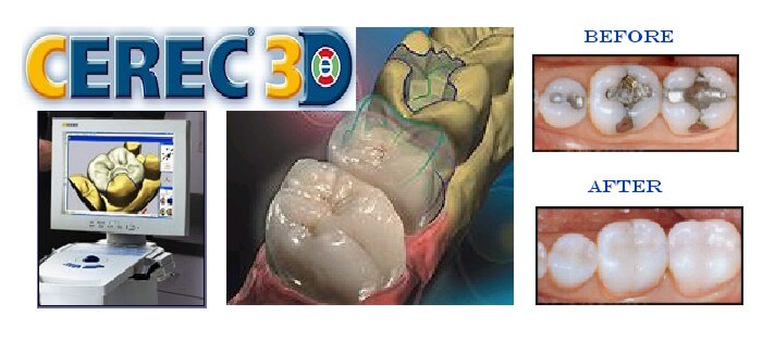 What is a Cerec, or one appointment crown? - DentisteAlaval